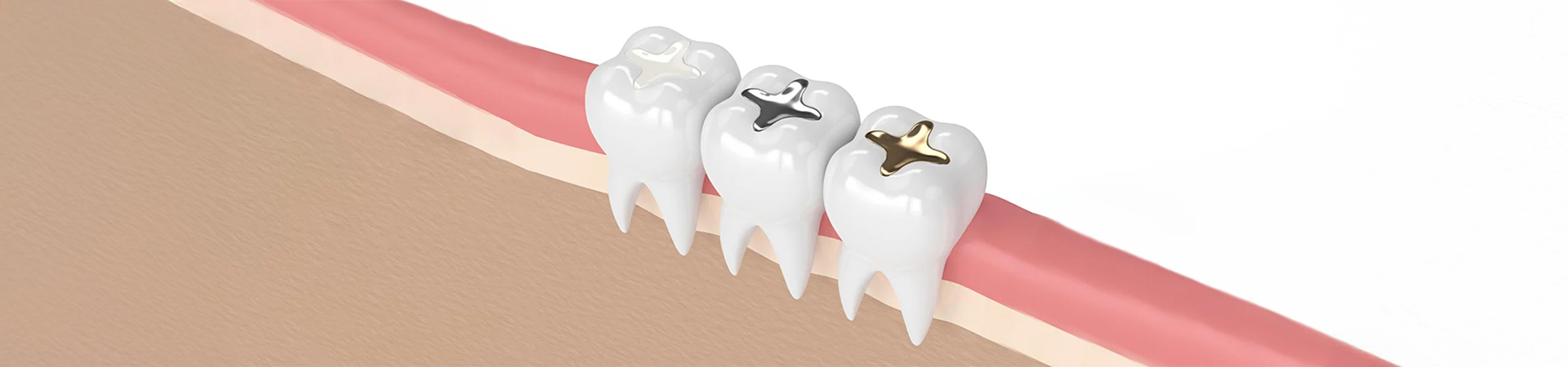 The Benefits of Choosing Tooth-Colored Fillings for Cavities